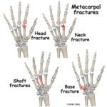 Broken Metacarpal | Metacarpal Fracture | Symptoms, treatment, surgery