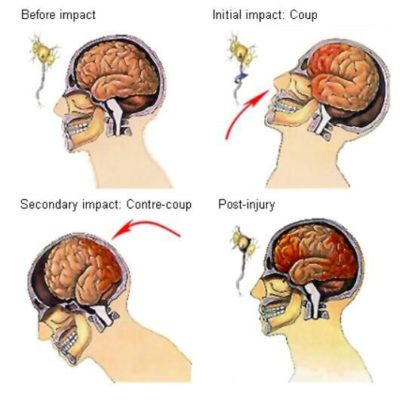 Second Impact Syndrome | Symptoms, treatment, recovery & stories