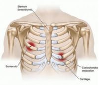 Rib Fracture and Pneumothorax Complication | SportsMD