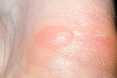 Propper Care of Blisters | Blister treatment and taping | SportsMD