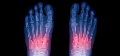 Midfoot Sprain | Diagnose, treatment and surgery options | SportsMD
