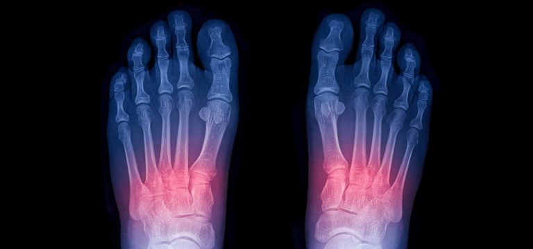 Midfoot Sprain | Diagnose, treatment and surgery options | SportsMD