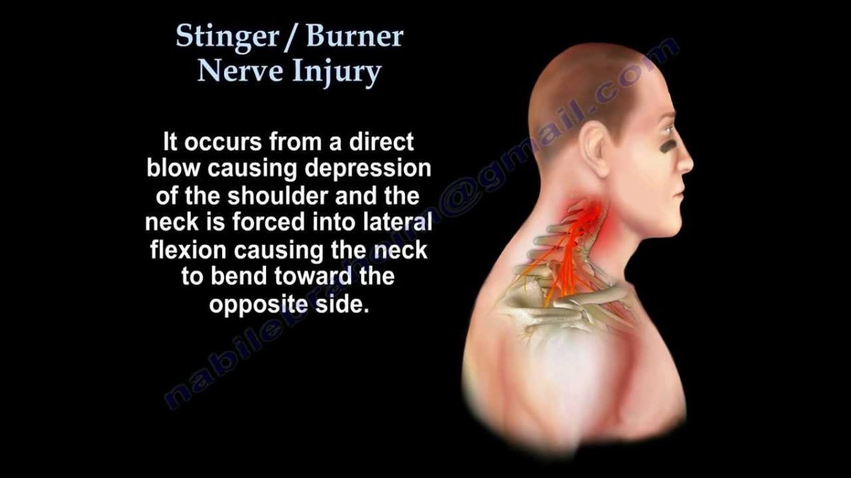 Stingers and Burners | Diagnosis, treatment & rehab exercises | SportsMD