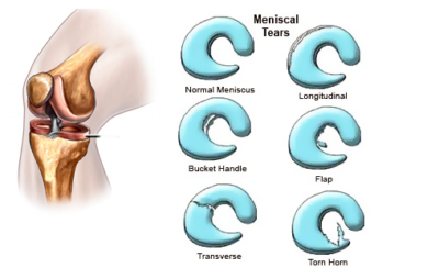 What is the Recovery Time for Meniscus Tear Surgery?