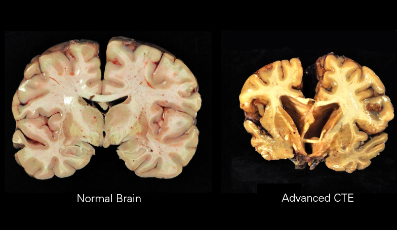 Chronic Traumatic Encephalopathy (CTE) - SportsMD