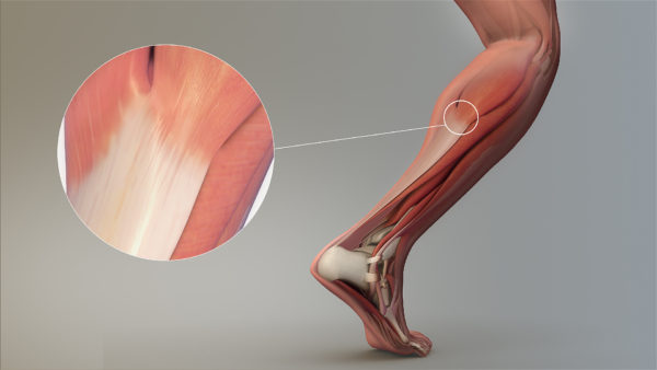 Tendon Pain: Do you have to accept pain to play a sport? SportsMD