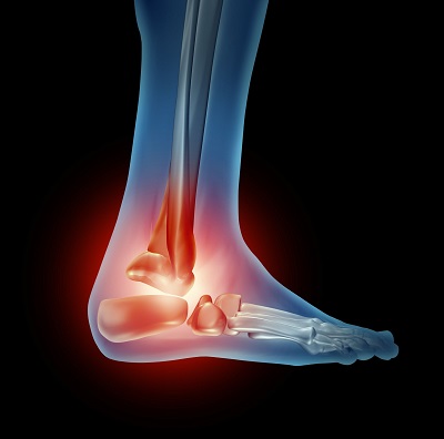Broken Ankle Surgery | Symptoms, treatment & surgery options