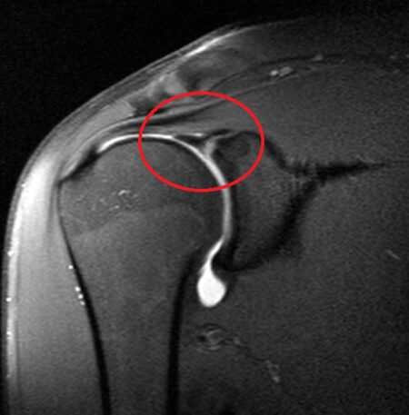 SLAP Tear Surgery - SportsMD