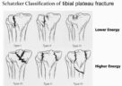 Tibial Plateau Fracture Surgery | Symtoms, Treatment & Recovery