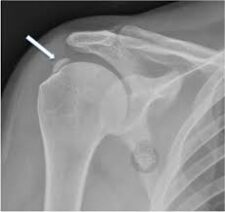 Calcific Tendonitis - SportsMD