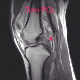 PCL Surgery Success Rate | PCL Tear | SportsMD