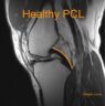 PCL Surgery Success Rate | PCL Tear | SportsMD