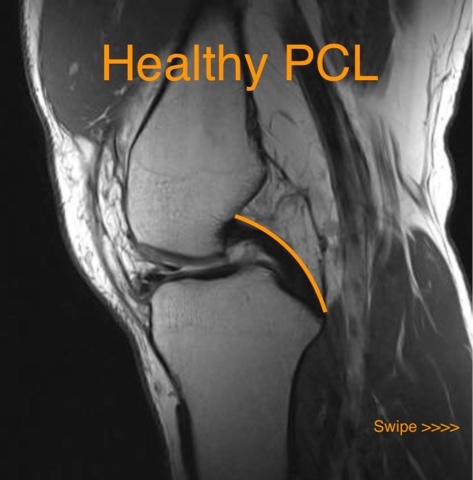 PCL Surgery Success Rate | PCL Tear | SportsMD