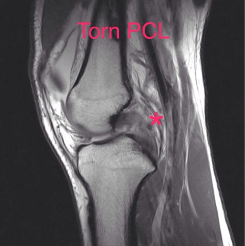 PCL Surgery Success Rate | PCL Tear | SportsMD