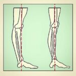 Knee Hyperextension - SportsMD