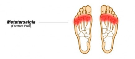 Metatarsalgia Symptoms, Causes, and Treatment - SportsMD