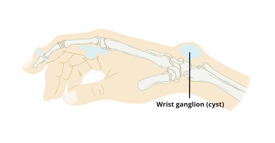 Ganglion Cyst on Wrist - SportsMD