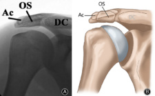 Os Acromiale - SportsMD