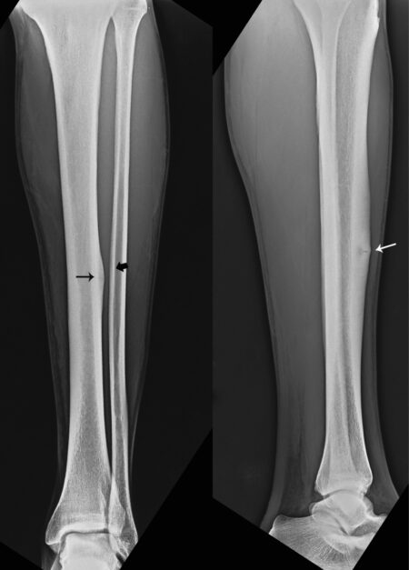 Stress Fractures in Shins and Lower Extremity - SportsMD